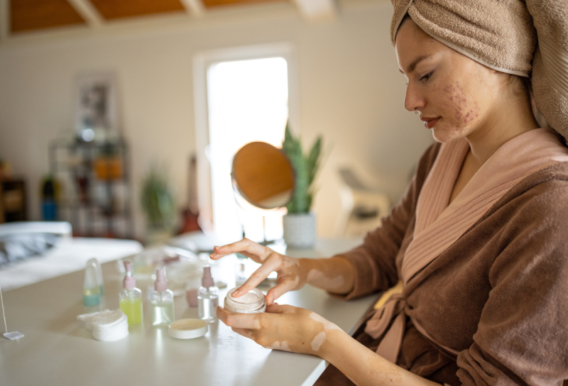 Az aknés hegek 3 típusa – Hogyan halványíthatjuk el?